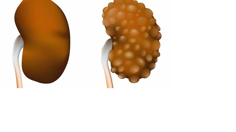 kyste atypique : symptômes, diagnostic et traitement